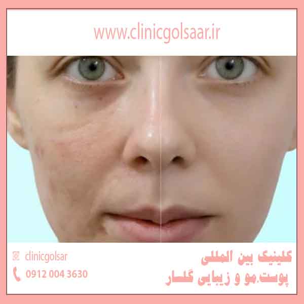 لیزر فرکشنال دکتر جان زیبایی گسار رشت